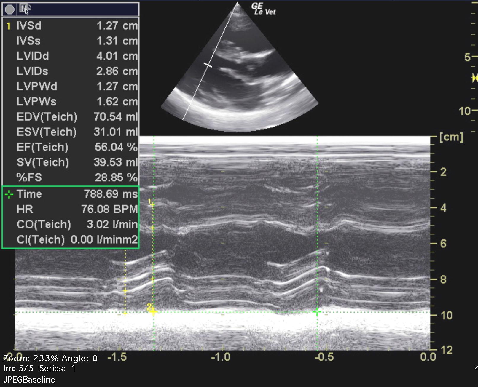 15-00222 Tilly E Subaortic stenosis and aortic regurg - Members