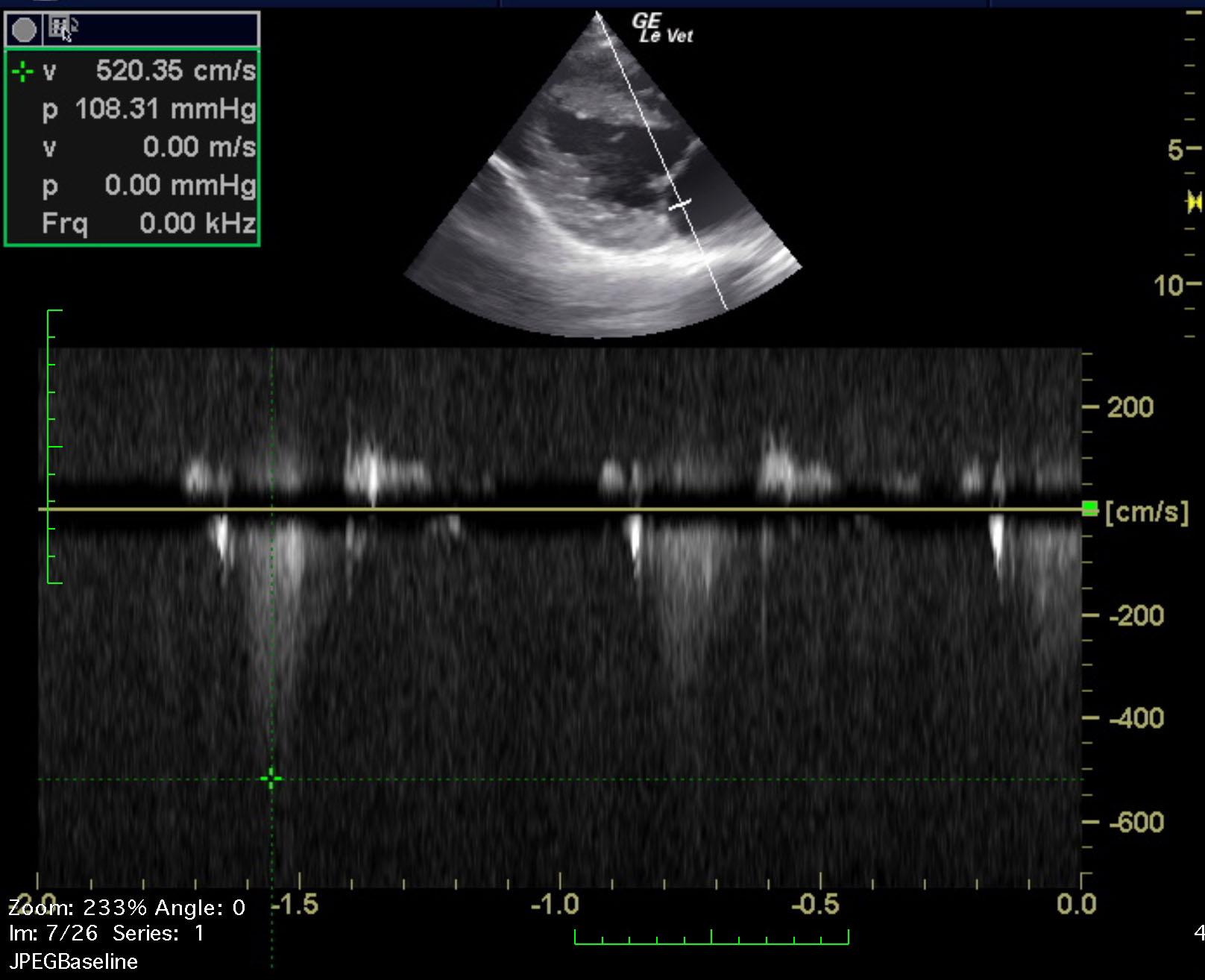 15-00222 Tilly E Subaortic stenosis and aortic regurg - Members