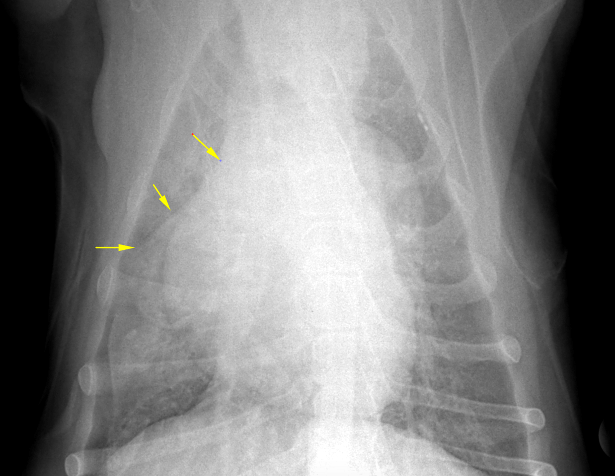 Rad - Geriatric changes and positional atelectasis of the middle lung ...