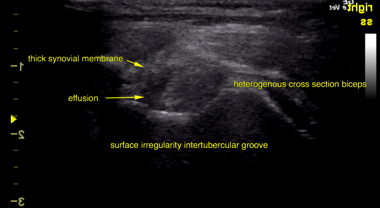 ORTHO - Chronic biceps tendinopathy and tenosynovitis with ...