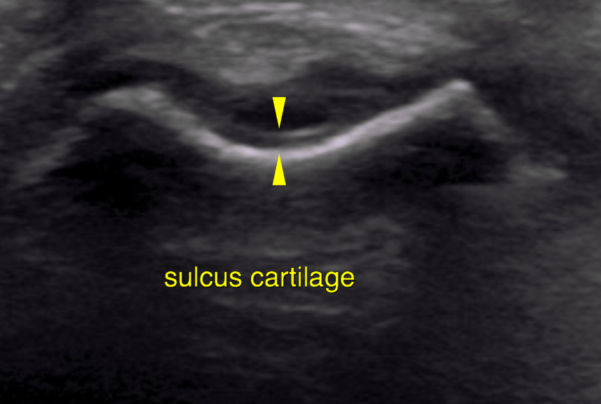 ORTHO - Left stifle cranial cruciate rupture with incomplete meniscal ...