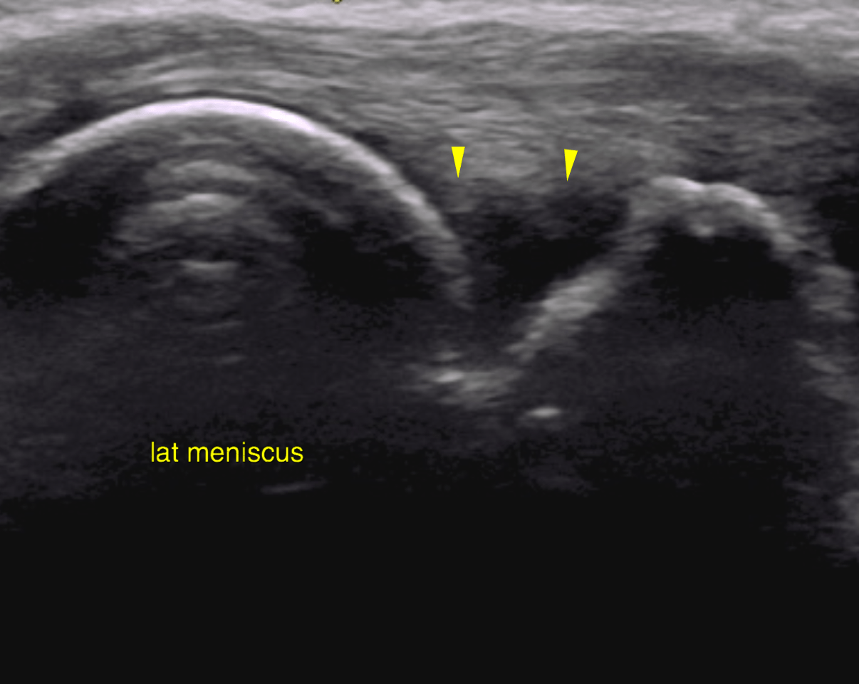 ORTHO - Left stifle cranial cruciate rupture with incomplete meniscal ...