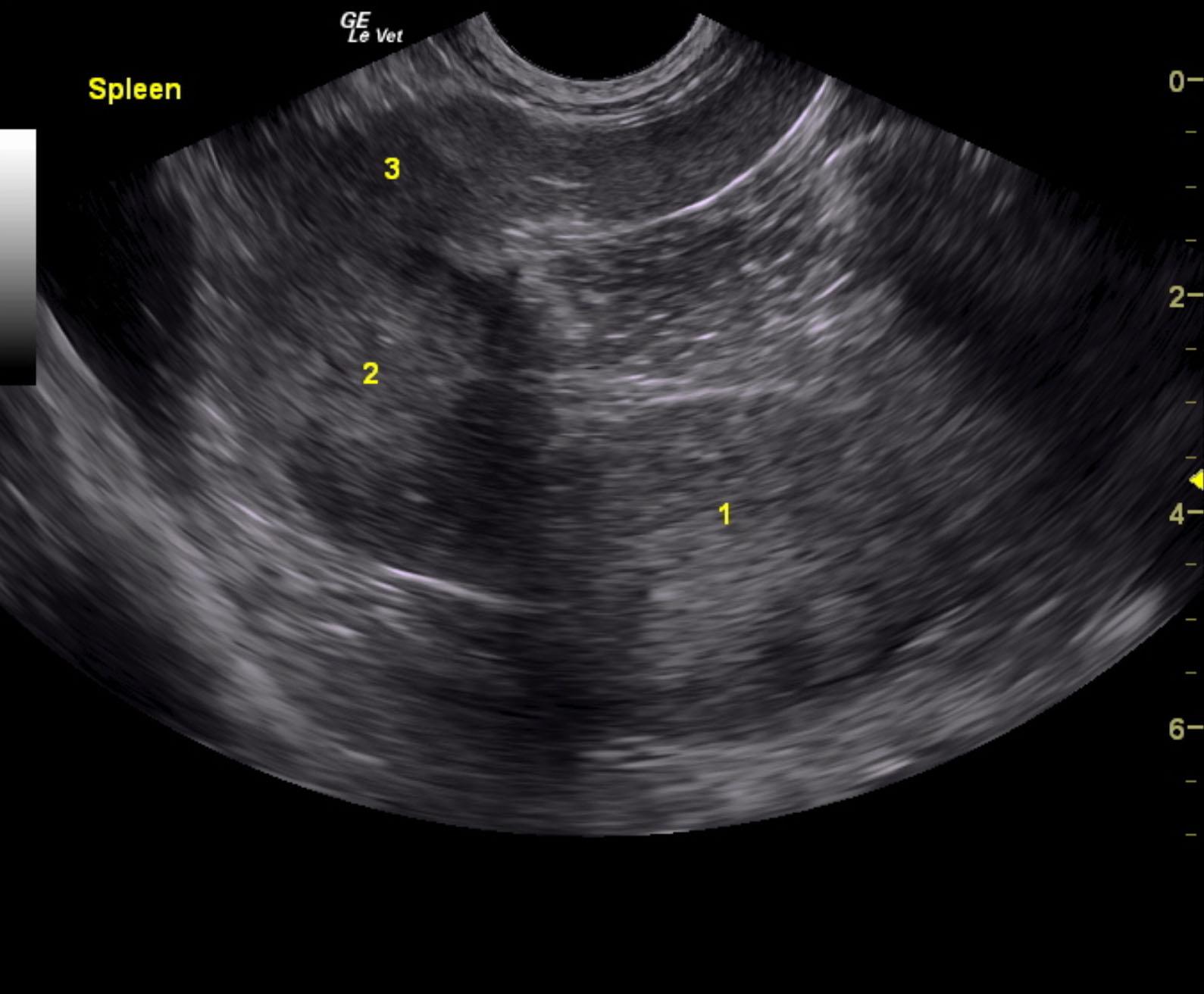 08_00156 Einstein M Splenic nodules, presumed mets from ASA