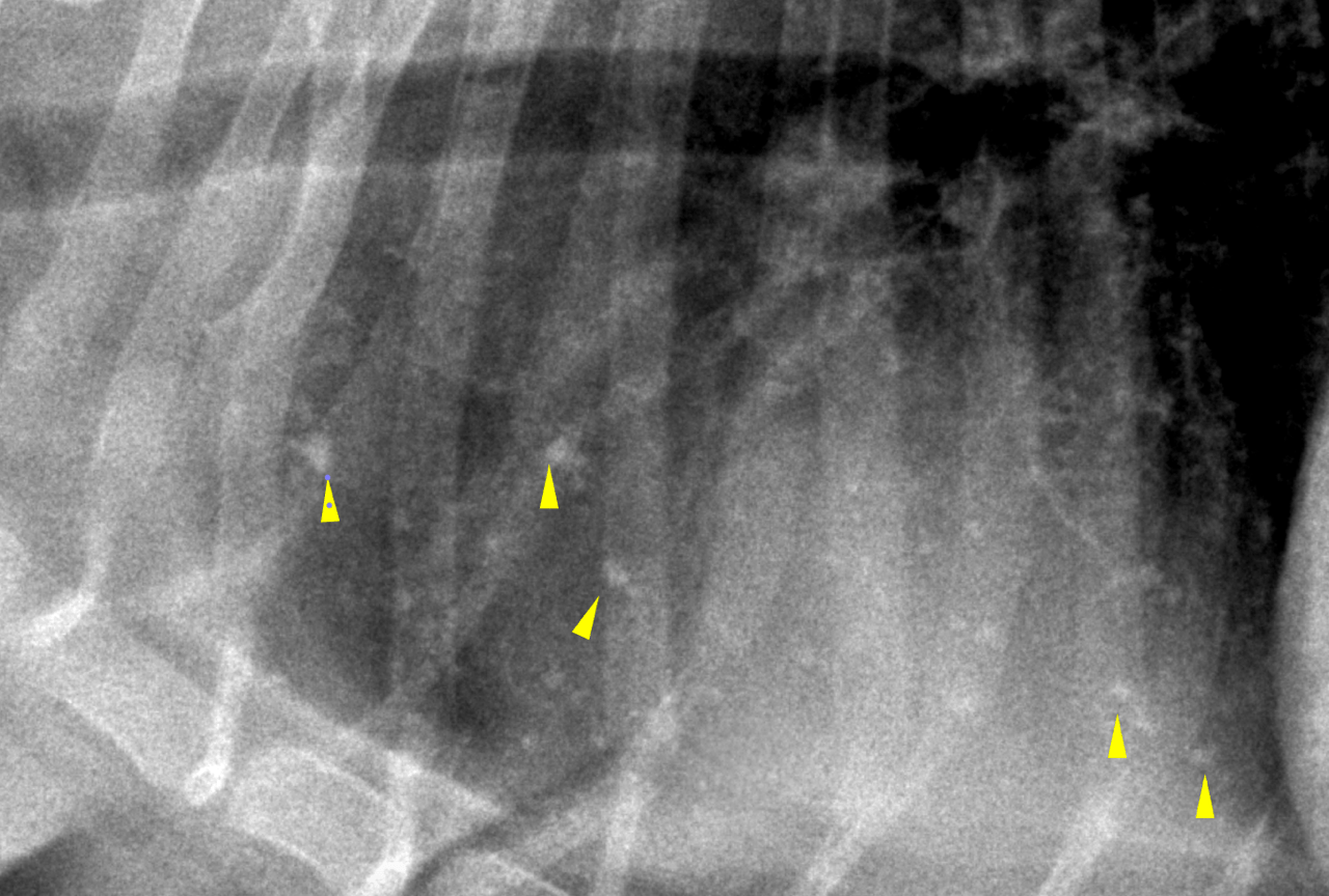 RAD - Age related incidental pulmonary osteomas/pleural plugs on ...