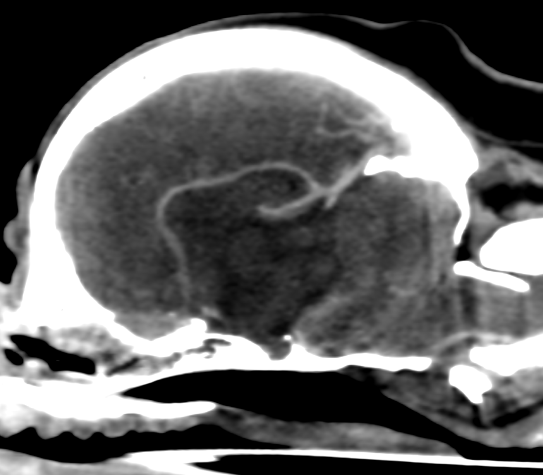 CT- Normal brain post head trauma with seizure activity in a 6 year old ...