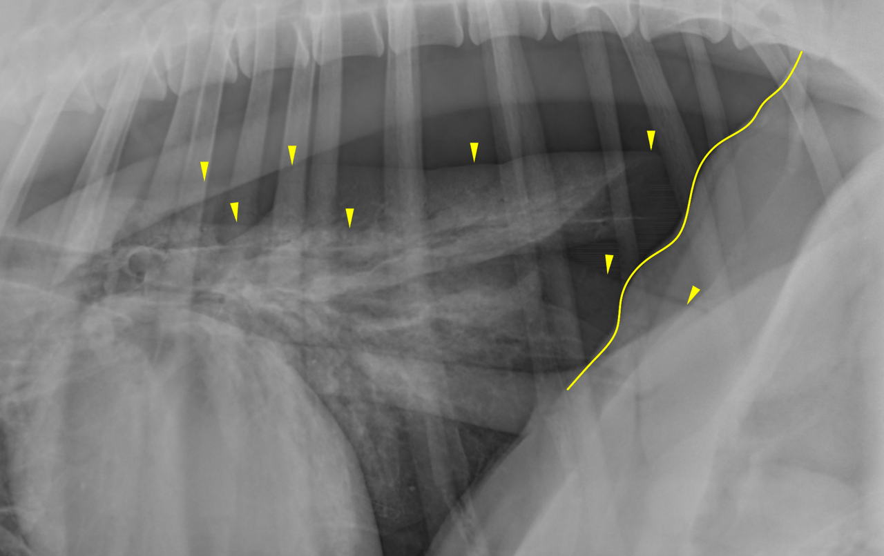 RAD - Spontaneous symmetric pneumothorax with pulmonary bullae, lung ...
