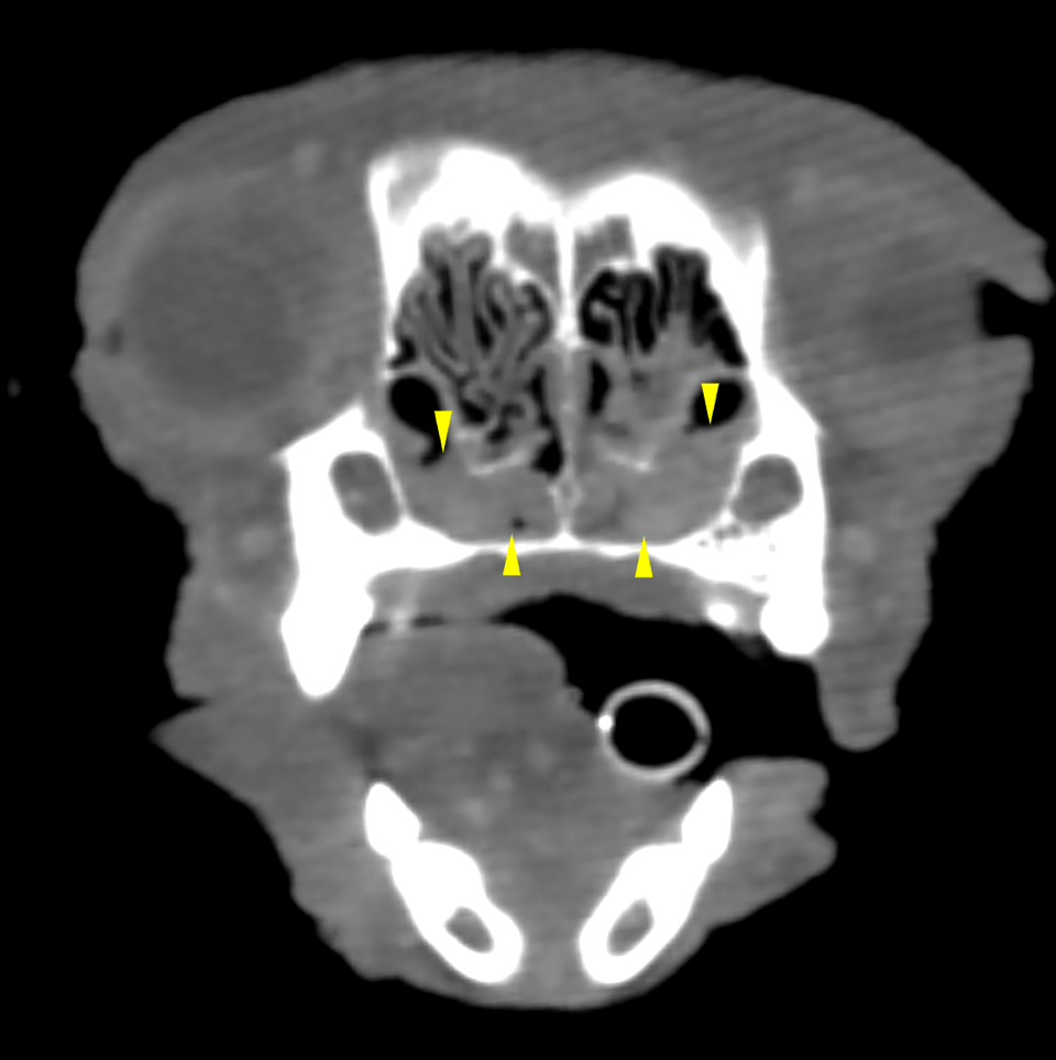 CT - Chronic non-specific rhinitis without destructive component in a ...