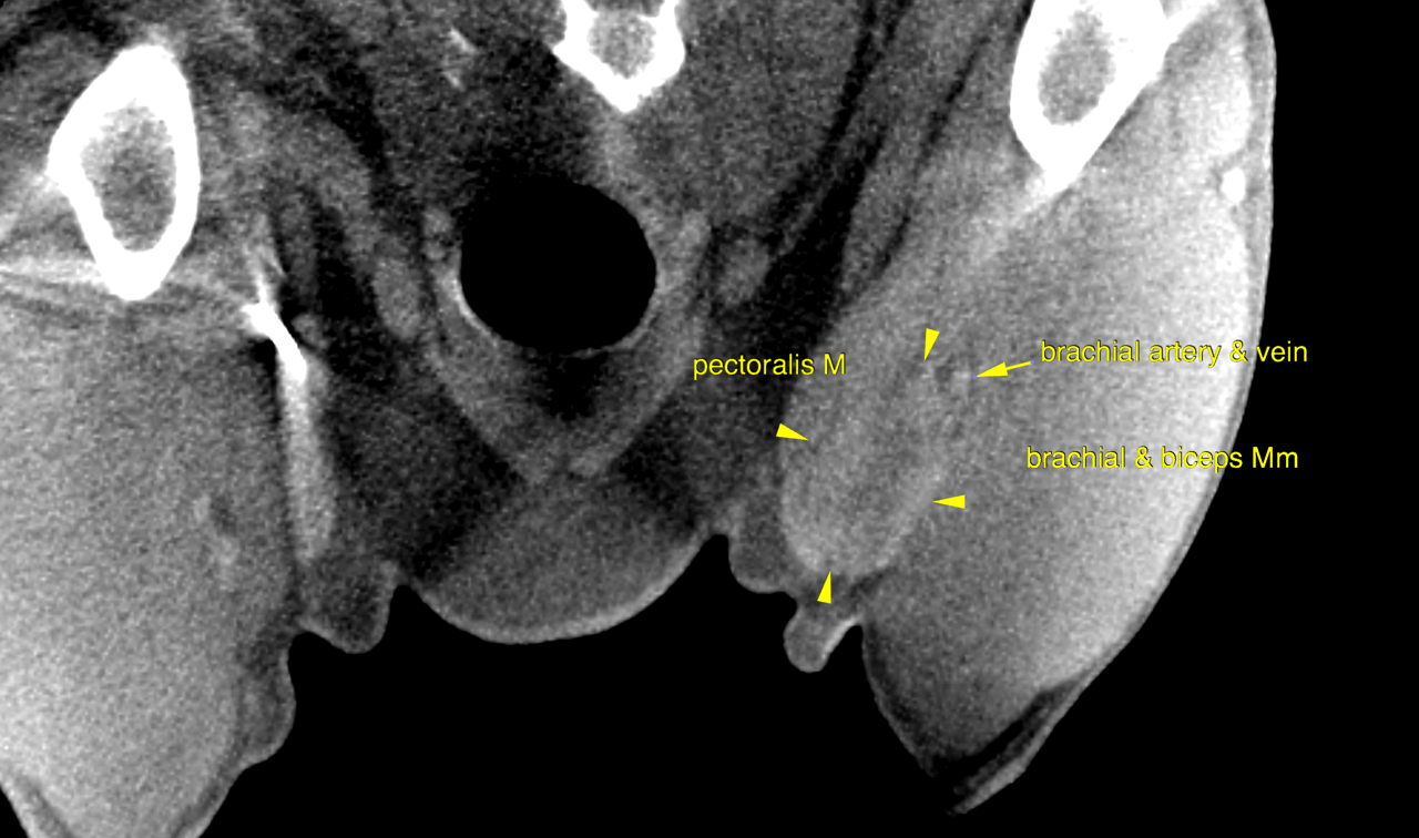 CT- soft tissue neoplasia with necrotic center within left axilla in a ...