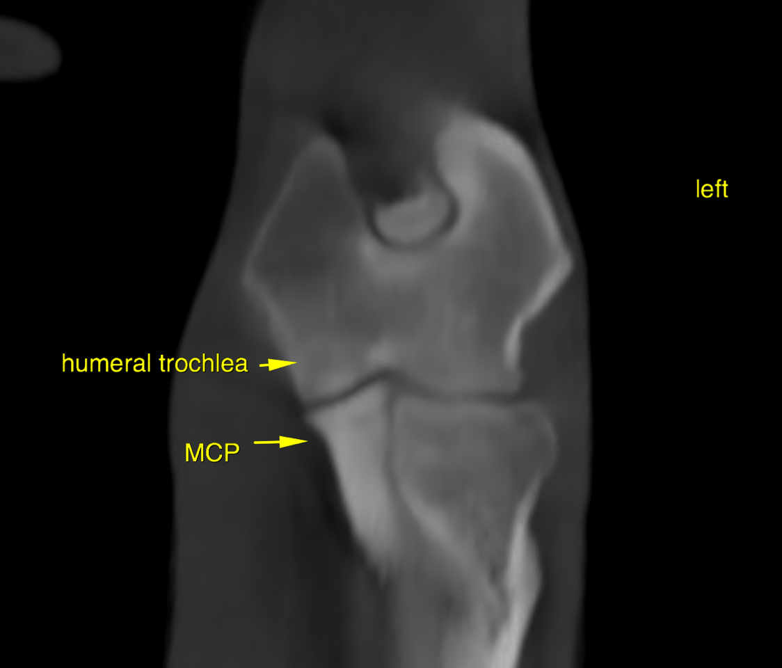 CT- Elbow osteoarthritis with joint incongruity and kissing lesion ...
