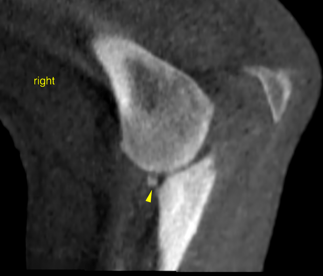 CT- bilateral elbow dysplasia in a 1 year old Bernese Mountain Dog ...