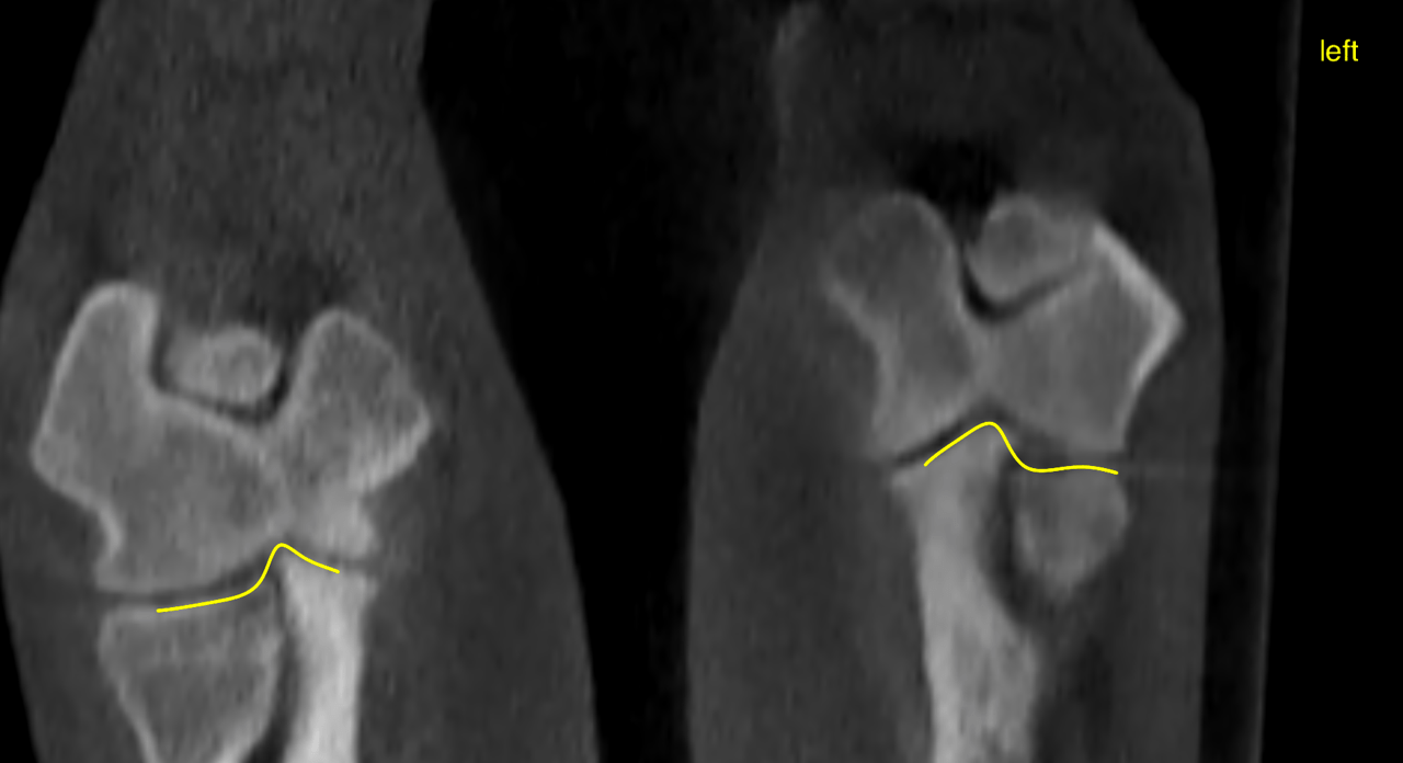 CT- bilateral elbow dysplasia in a 1 year old Bernese Mountain Dog ...