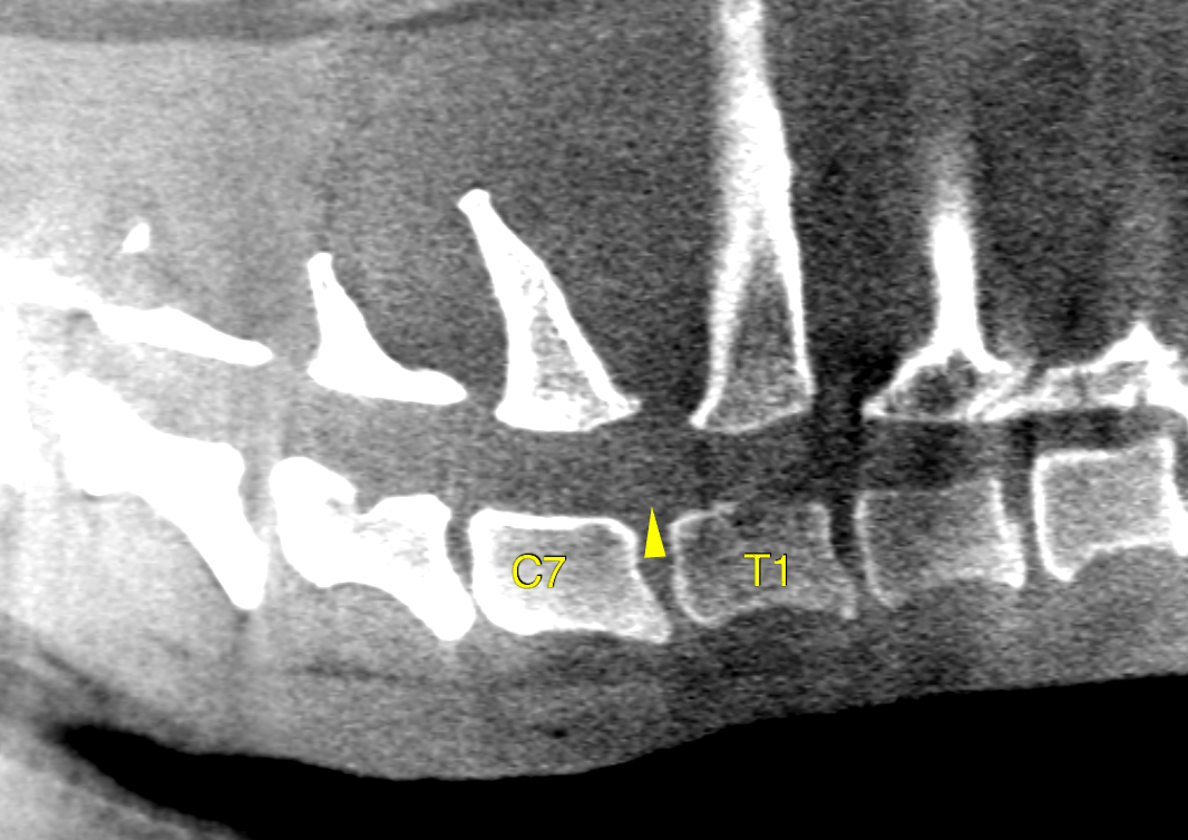 CT- Degenerative lumbosacral stenosis with disc protrusion and ...