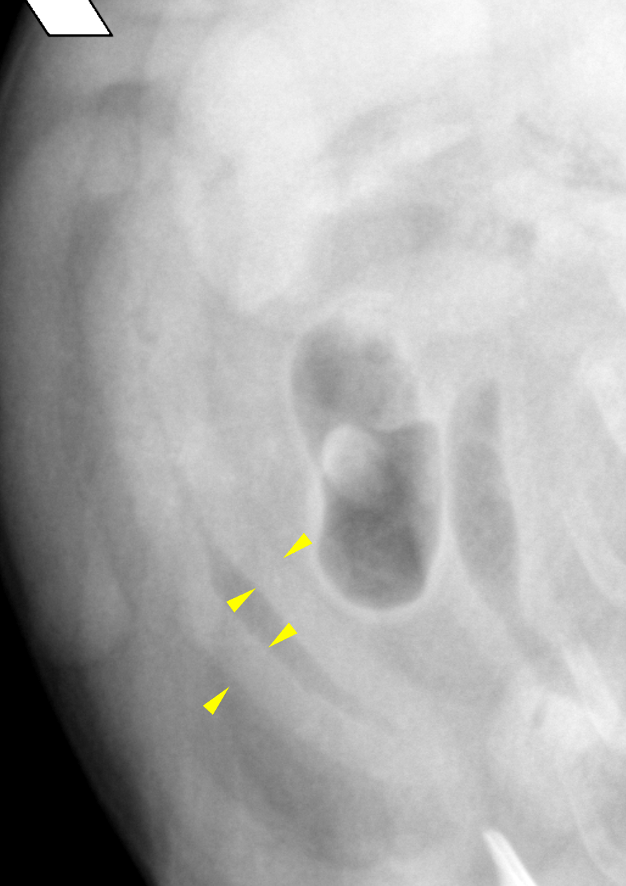 RAD - Left-sided congestive heart failure (CHF) with cardiogenic ...