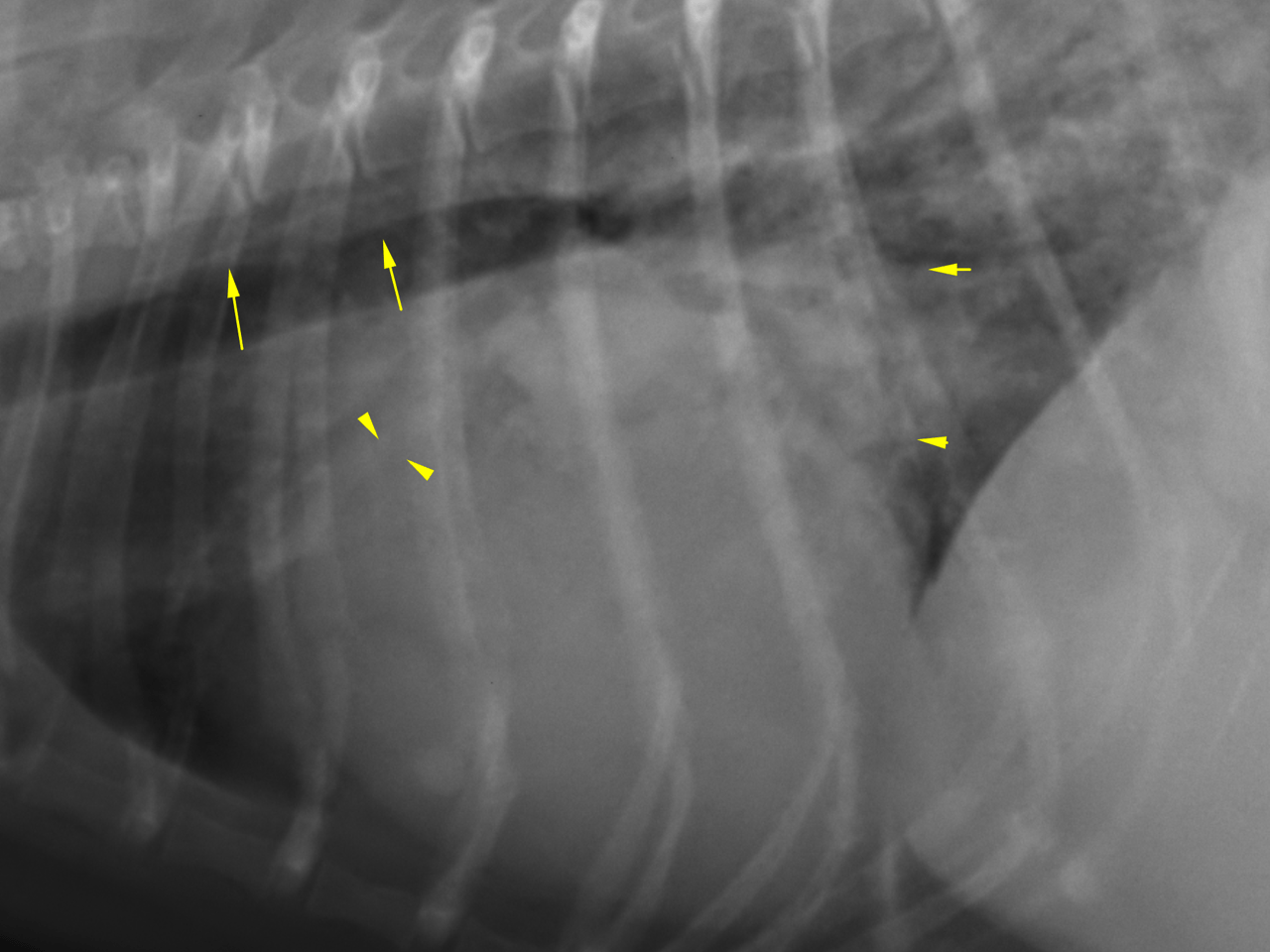 RAD - Left-sided congestive heart failure (CHF) with cardiogenic ...