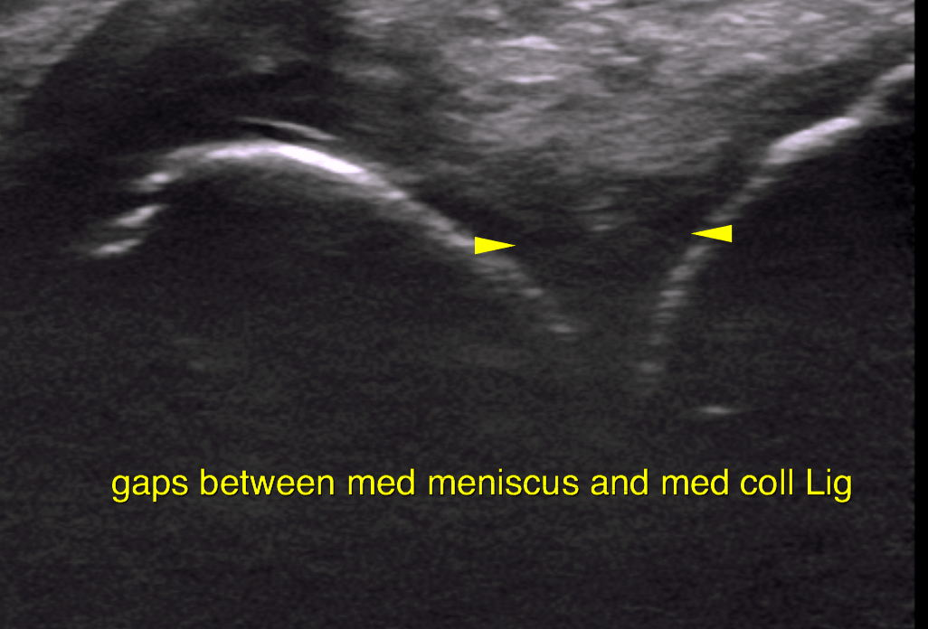 ORTHO -Chronic degenerative joint disease (DJD) with cranial cruciate ...