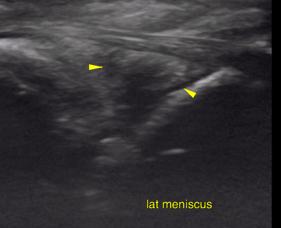 ORTHO -Chronic degenerative joint disease (DJD) with cranial cruciate ...