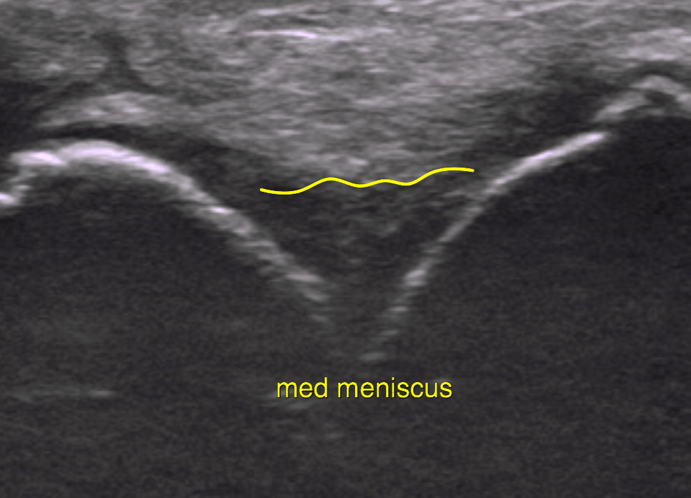ORTHO -Chronic degenerative joint disease (DJD) with cranial cruciate ...