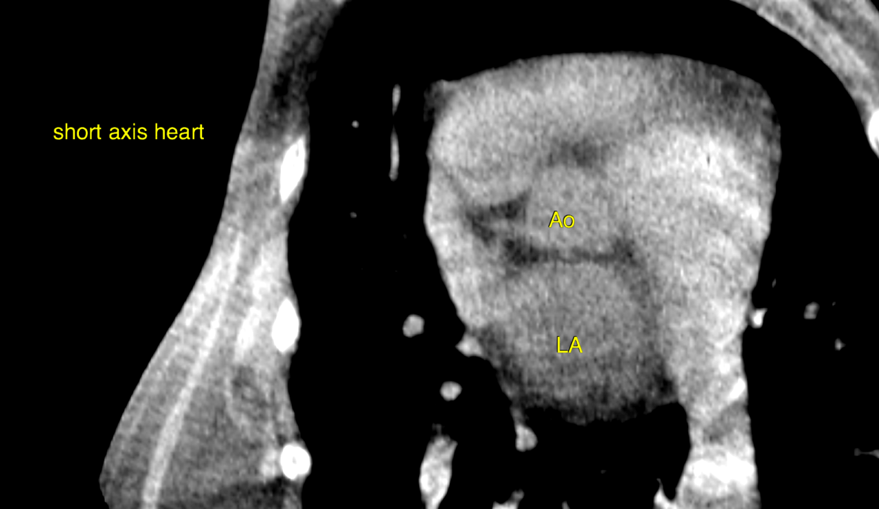 CT - Disseminated cylindrical peripheral bronchiectasis without ...