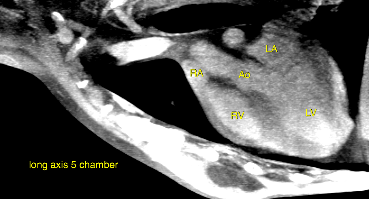 CT - Disseminated cylindrical peripheral bronchiectasis without ...