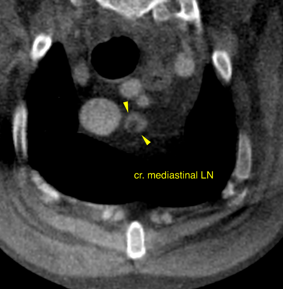 CT - Disseminated cylindrical peripheral bronchiectasis without ...
