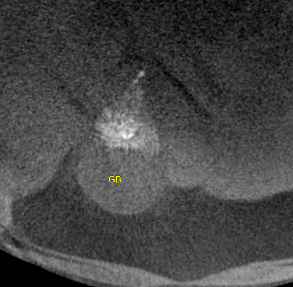 CT - Disseminated cylindrical peripheral bronchiectasis without ...