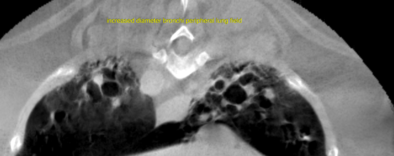 CT - Disseminated cylindrical peripheral bronchiectasis without ...