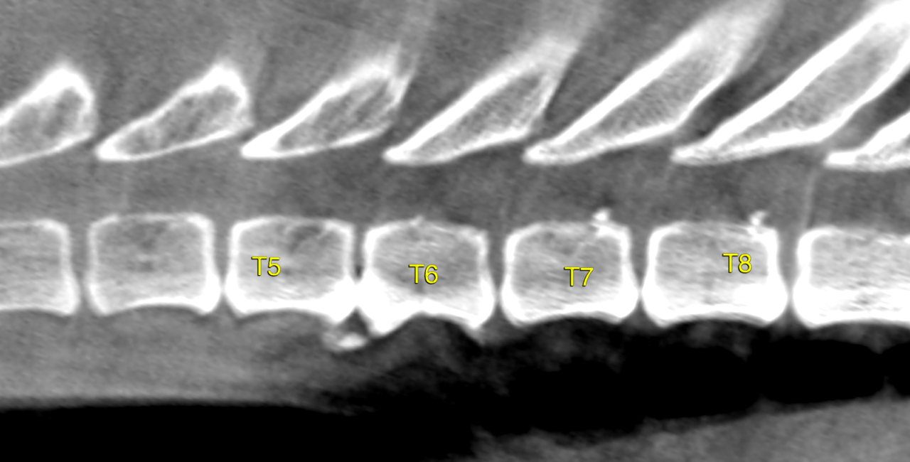 CT - Degenerative lumbosacral stenosis with intervertebral disc ...
