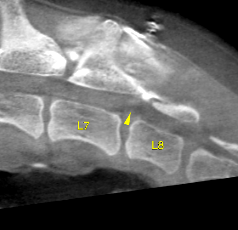 CT - Degenerative lumbosacral stenosis with intervertebral disc ...