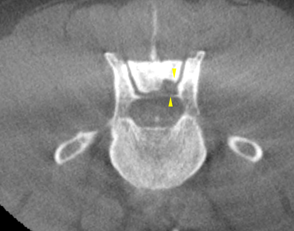 CT - Degenerative lumbosacral stenosis with intervertebral disc ...