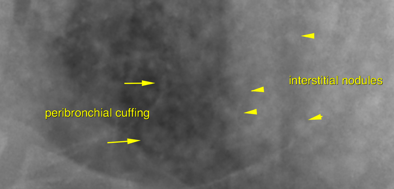RAD - Severe military lung pattern with peribronchial cuffing and ...