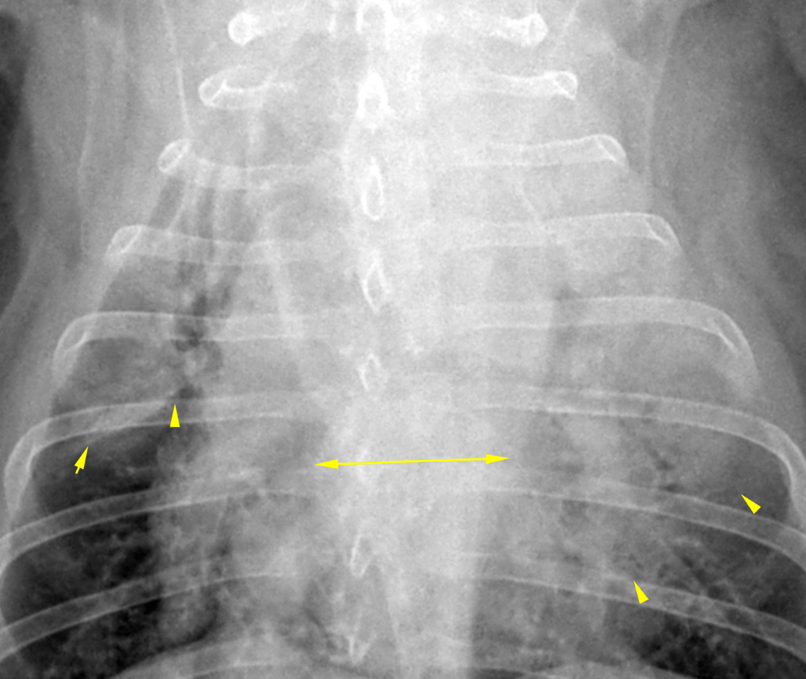 RAD - Alveolar consolidation of the lung consistent with infectious ...