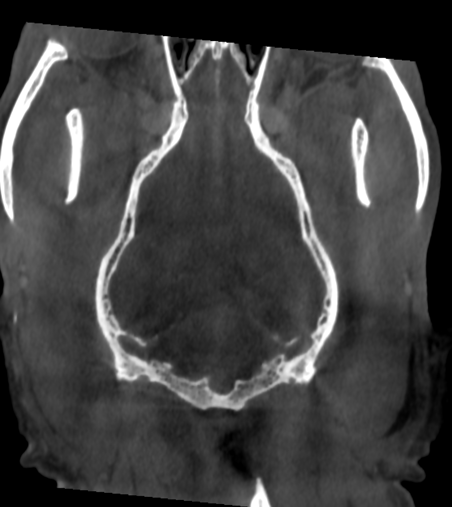 CT - Chronic otitis media with inflammation and reactive lymphadenitis ...