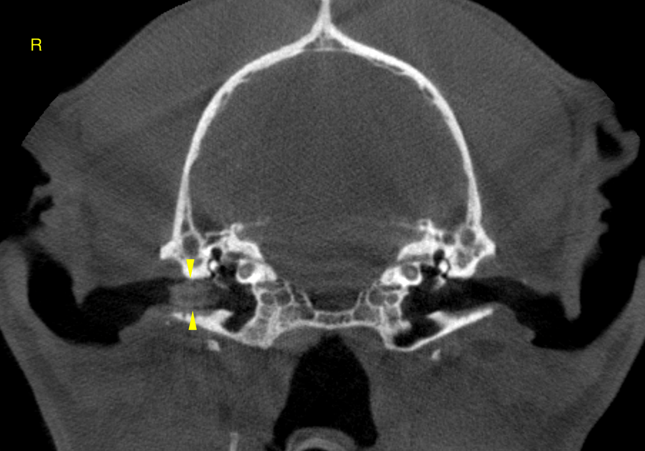 CT - Bilateral unspecific chronic mildly destructive rhinitis in a 4 ...