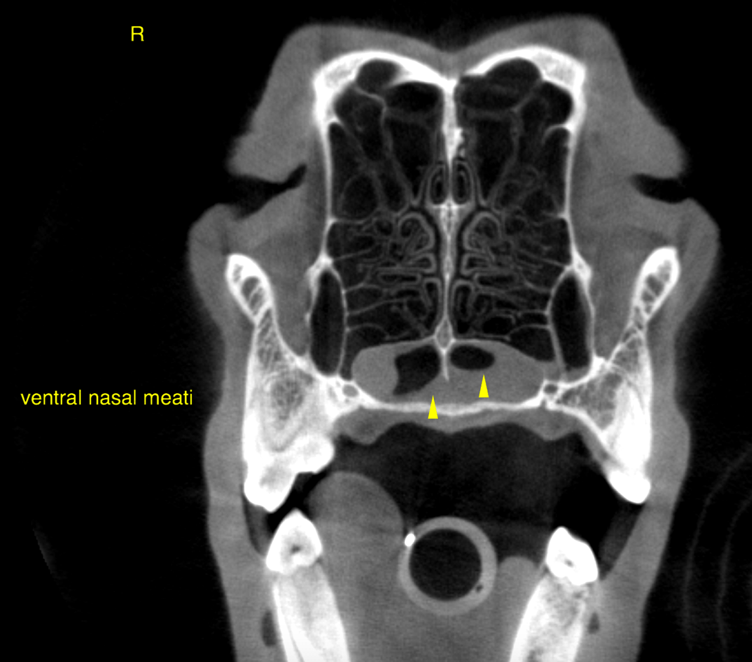 CT - Bilateral unspecific chronic mildly destructive rhinitis in a 4 ...