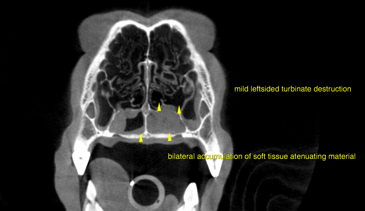 CT - Bilateral unspecific chronic mildly destructive rhinitis in a 4 ...