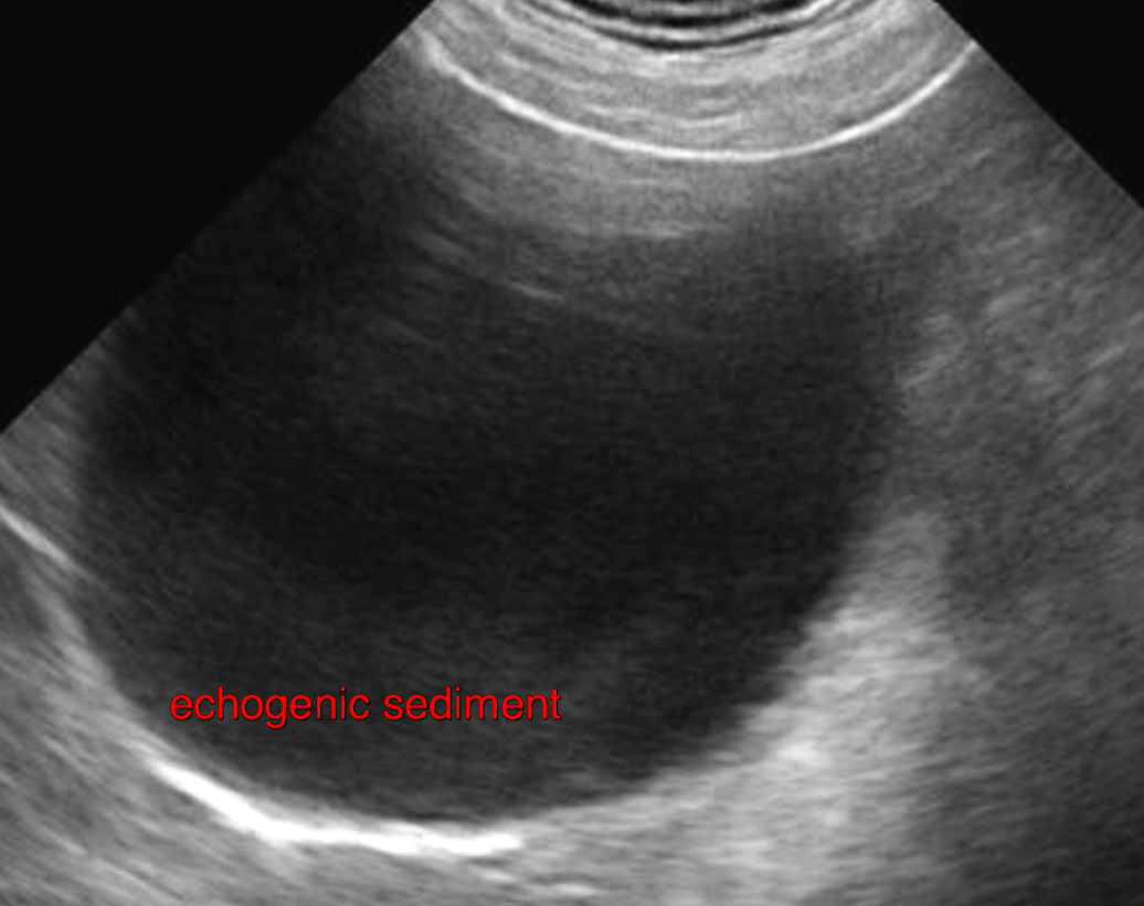 RADS and US - Nephritis, splenomegaly, hypovolemia and microcardia ...