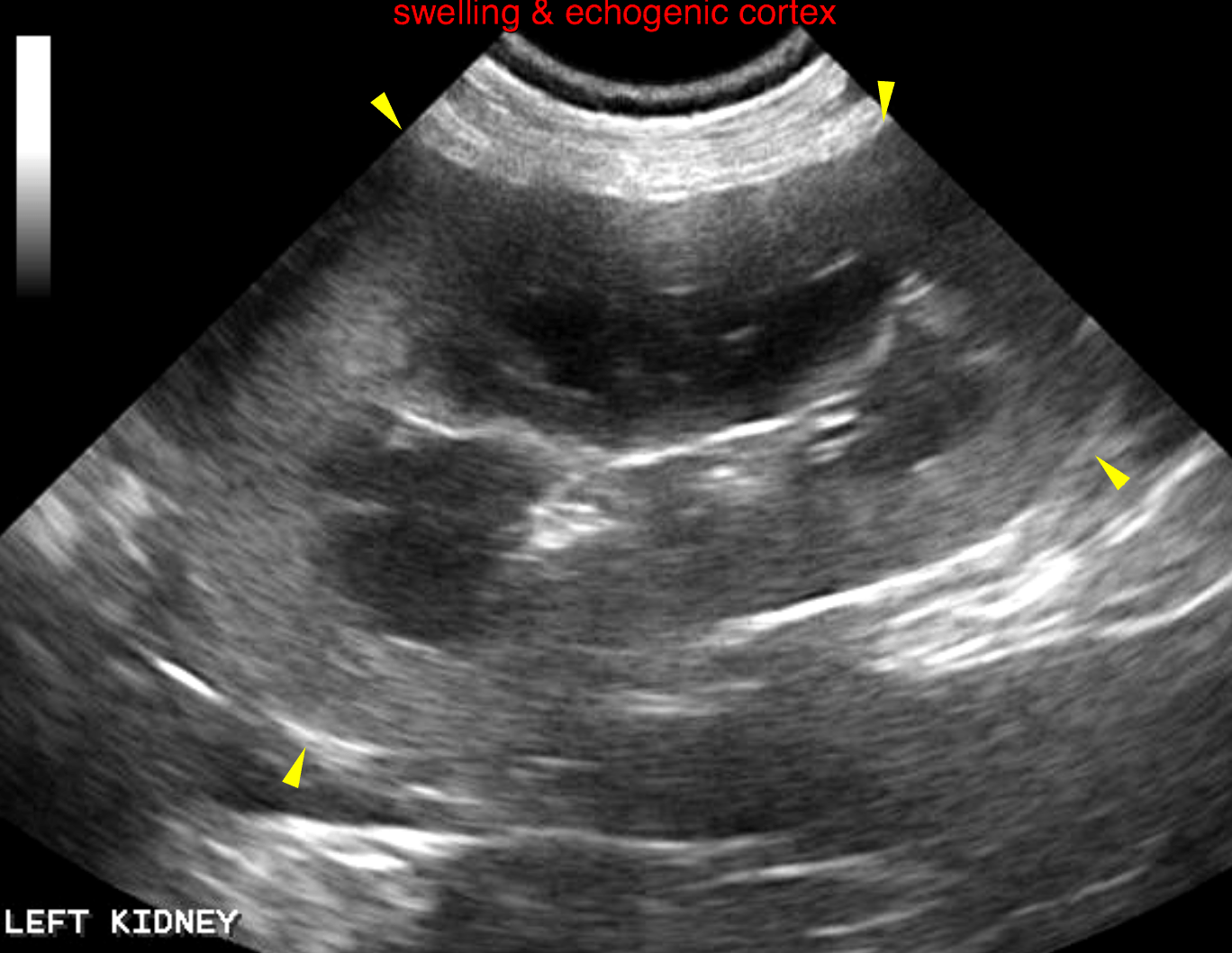 RADS and US - Nephritis, splenomegaly, hypovolemia and microcardia ...