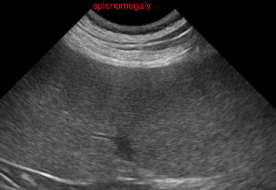 RADS and US - Nephritis, splenomegaly, hypovolemia and microcardia ...