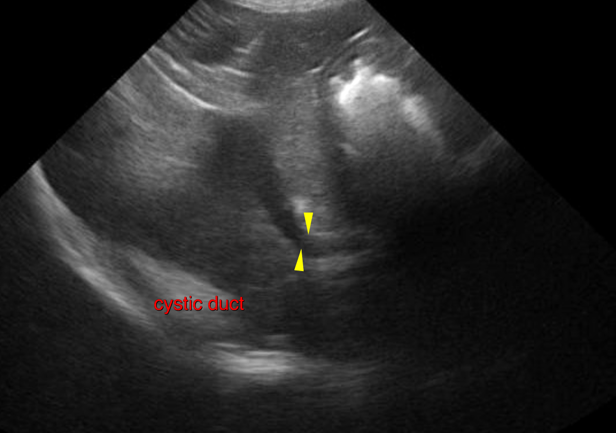 RADS and US - Nephritis, splenomegaly, hypovolemia and microcardia ...