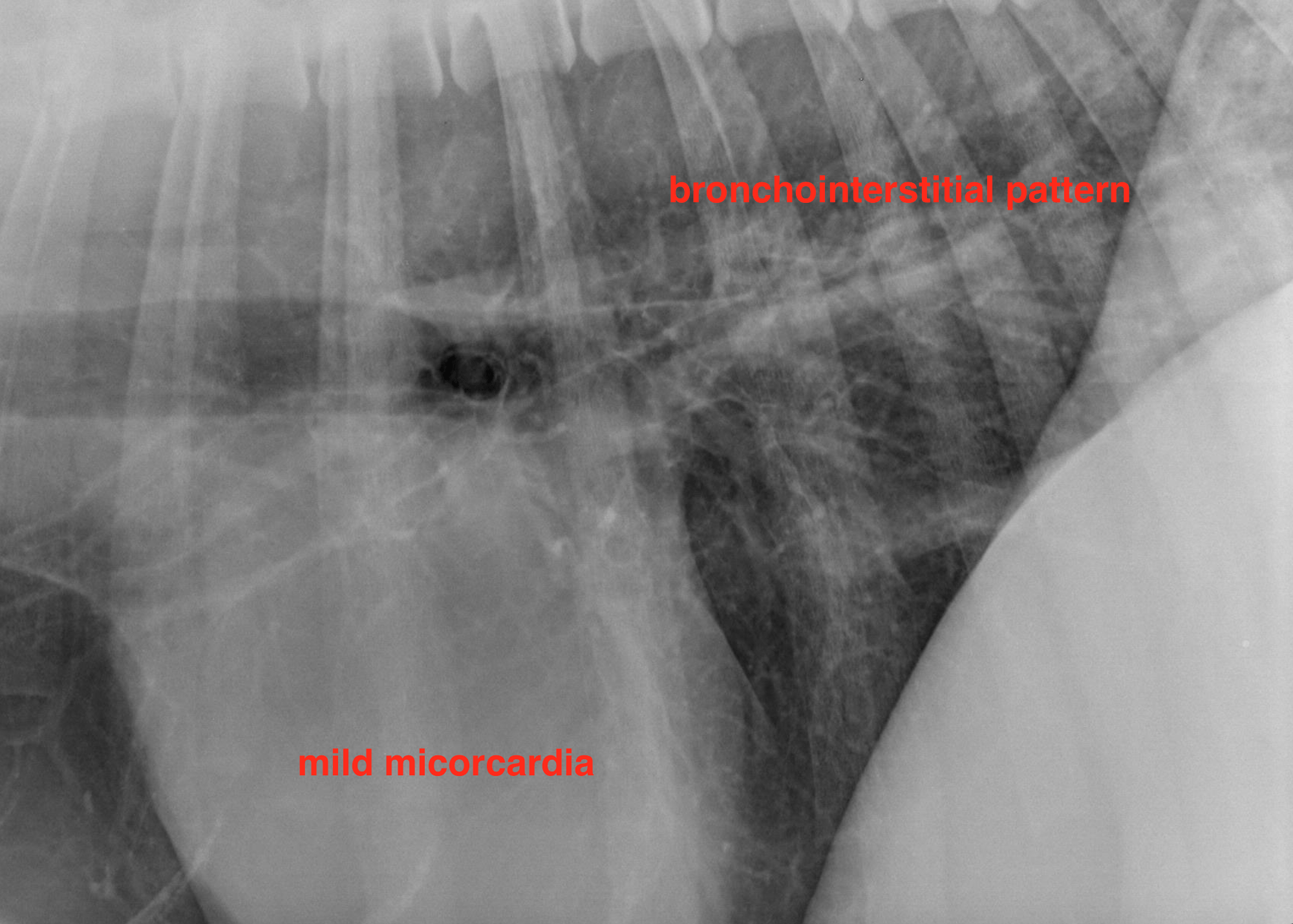 RADS and US - Nephritis, splenomegaly, hypovolemia and microcardia ...