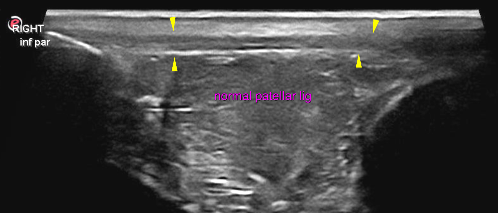 ORTHO - Chronic partial avulsion rupture of the patellar ligament, pre ...
