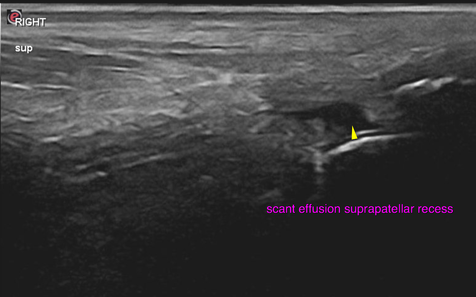 ORTHO - Chronic partial avulsion rupture of the patellar ligament, pre ...