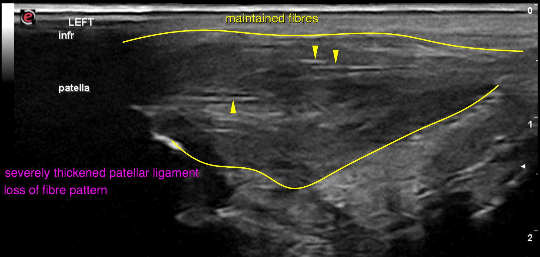 ORTHO - Chronic partial avulsion rupture of the patellar ligament, pre ...