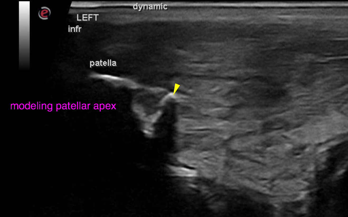 ORTHO - Chronic partial avulsion rupture of the patellar ligament, pre ...