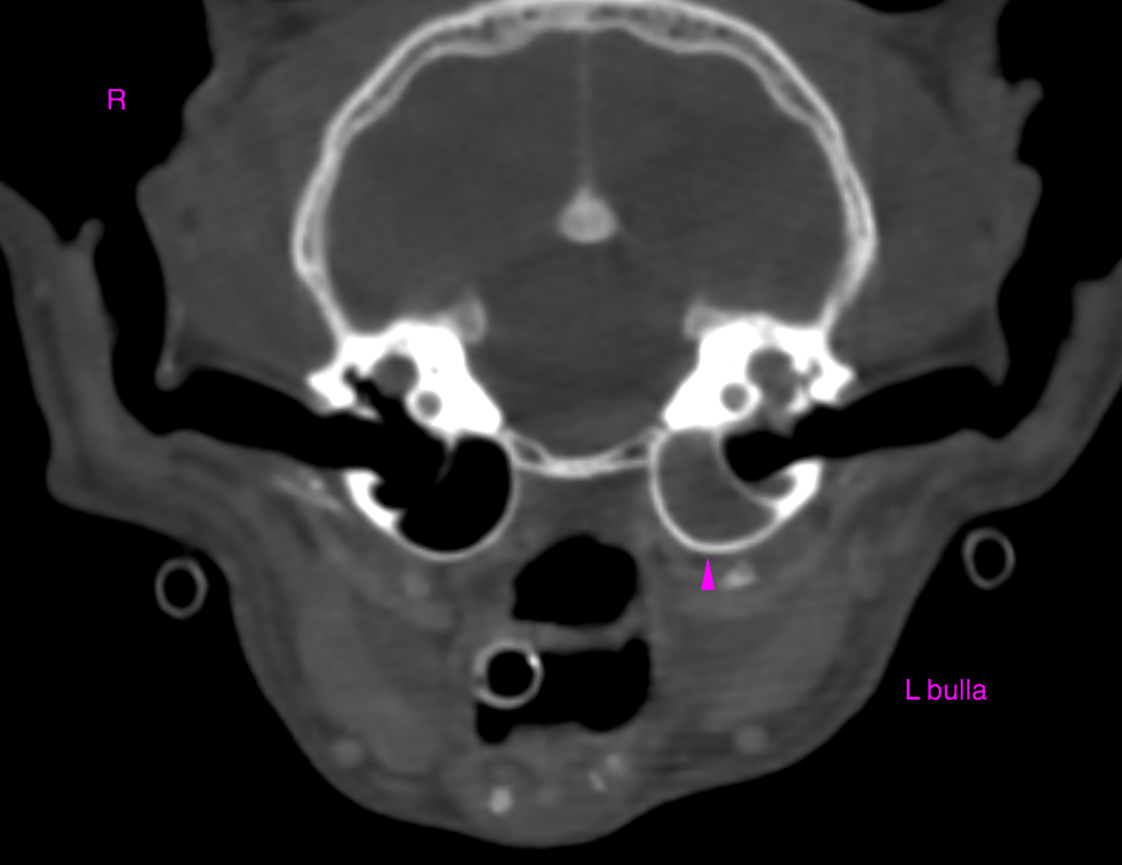 CT - Chronic bilateral rhinitis with conceal lysis and nasal septal ...