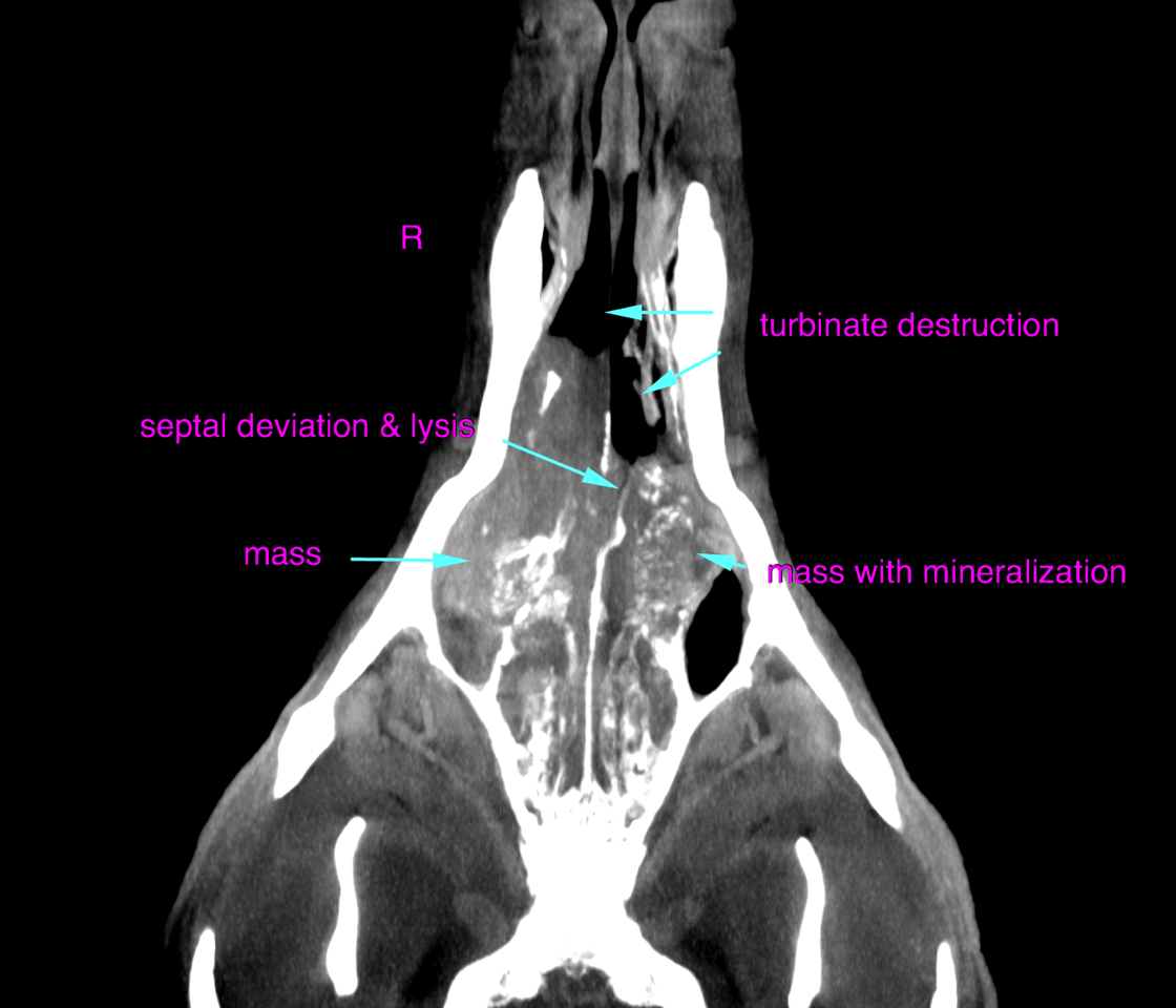 CT - right and left sided nasal masses with secretory sinusitis in a 9 ...