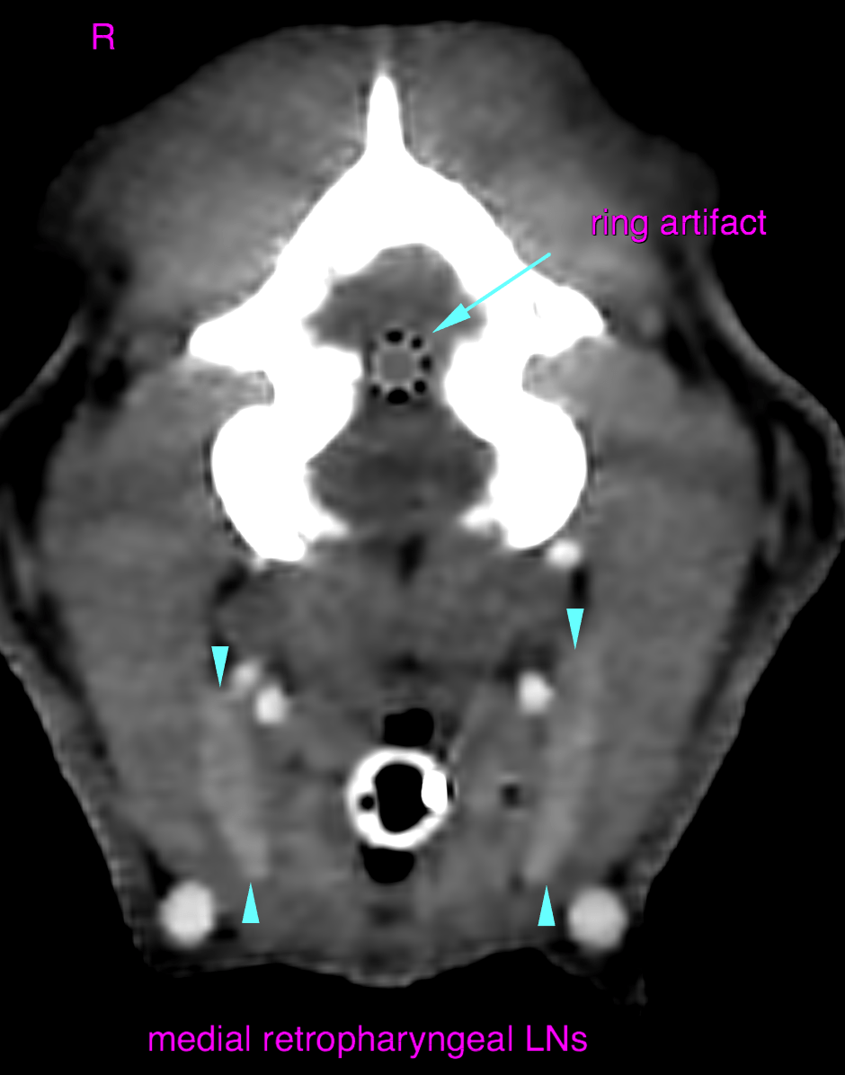 CT - Bilateral non-destructive rhinitis and sinusitis causing upper ...