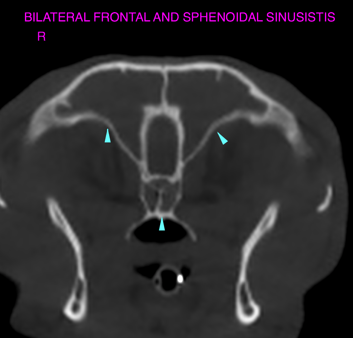 CT - Bilateral non-destructive rhinitis and sinusitis causing upper ...