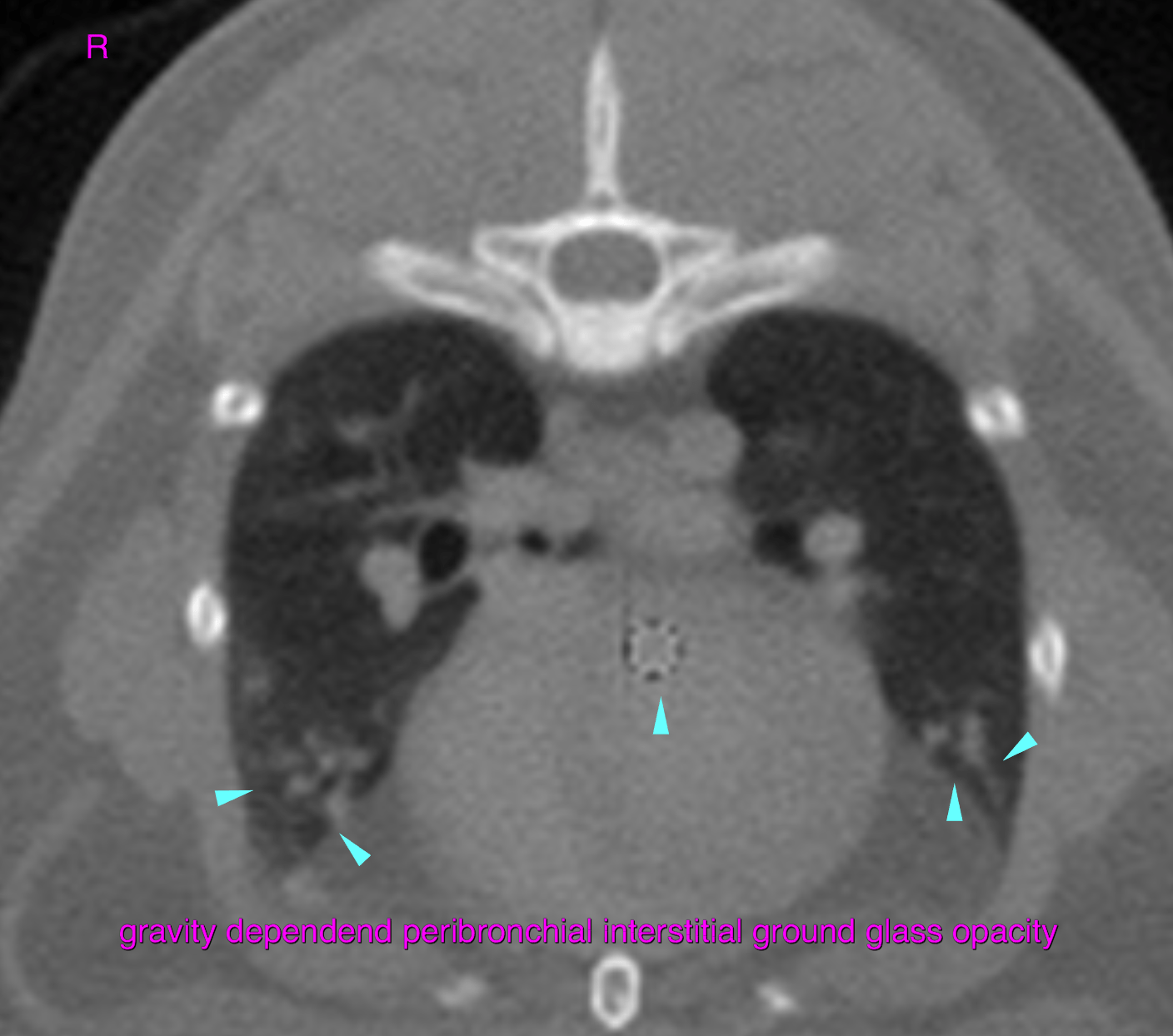 CT - Bilateral non-destructive rhinitis and sinusitis causing upper ...