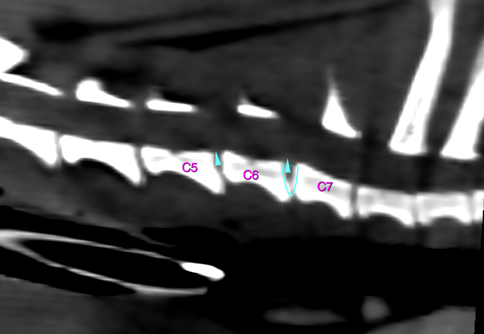 CT - Intervertebral disc disease (IVDD) with compressive myelopathy in ...